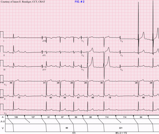 Left ventricular hypertrophy | ECG Guru - Instructor Resources Left ventricular hypertrophy | ECG Guru - Instructor Resources